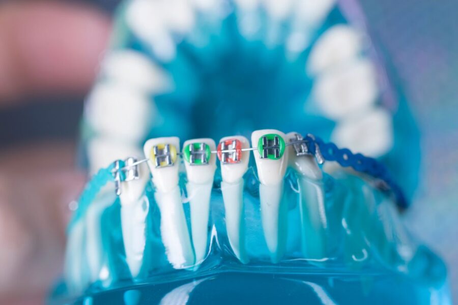 ¿Qué son los brackets invisibles y qué tipos hay?