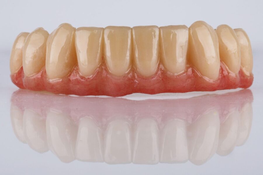 Pilares locator para implantes: Guía completa (2024) - Laborprothesis